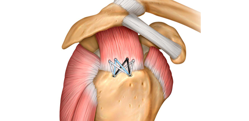 Twist Anchors - Plasmaconcept